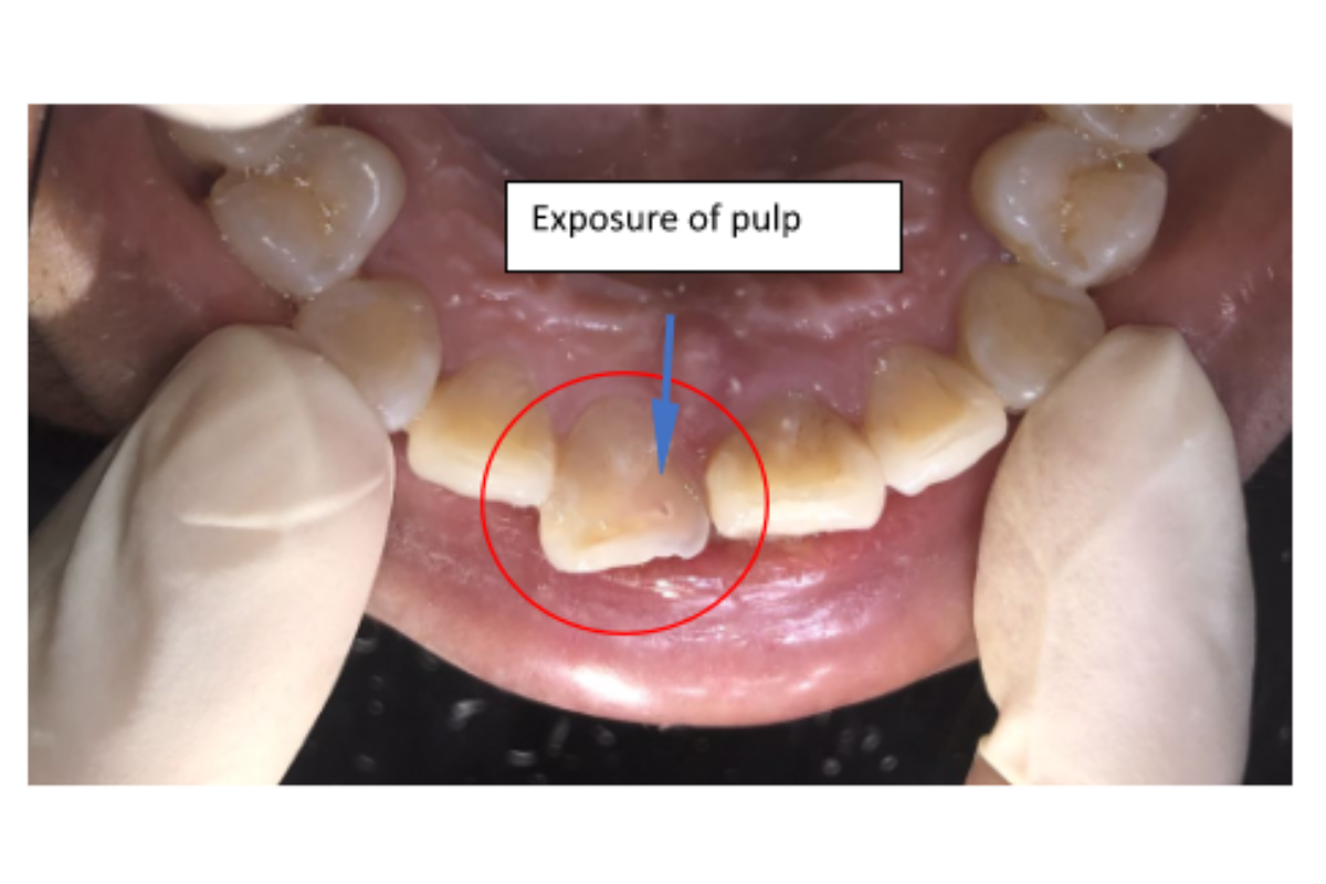 Dental Trauma Before Chinese New Year - White Density