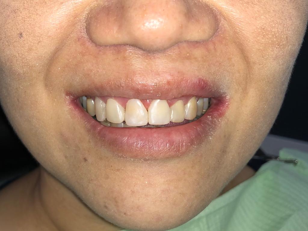 Lyn's Smile Transformation: From Shy to Radiant - White Density