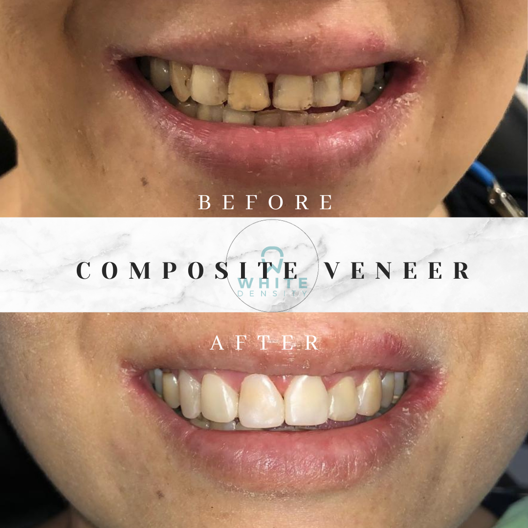 Lyn's Smile Transformation: From Shy to Radiant - White Density